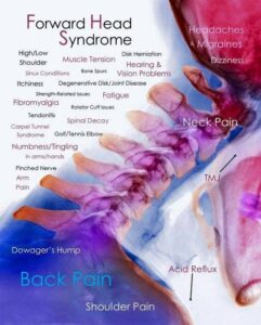Forward Head Syndrome - Align Chiropractic Wellness Center